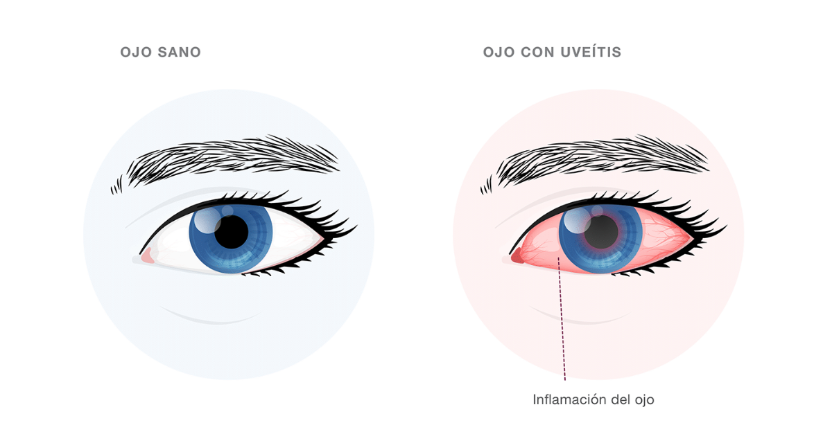 Uveítis: qué es, causas, síntomas y cómo tratarla