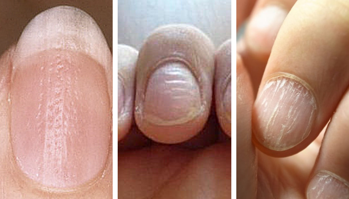 Uñas Onduladas Causas Y Qué Hacer E Consejos