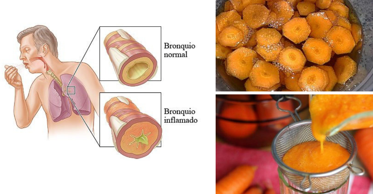 Expectorante casero: conoce los mejores